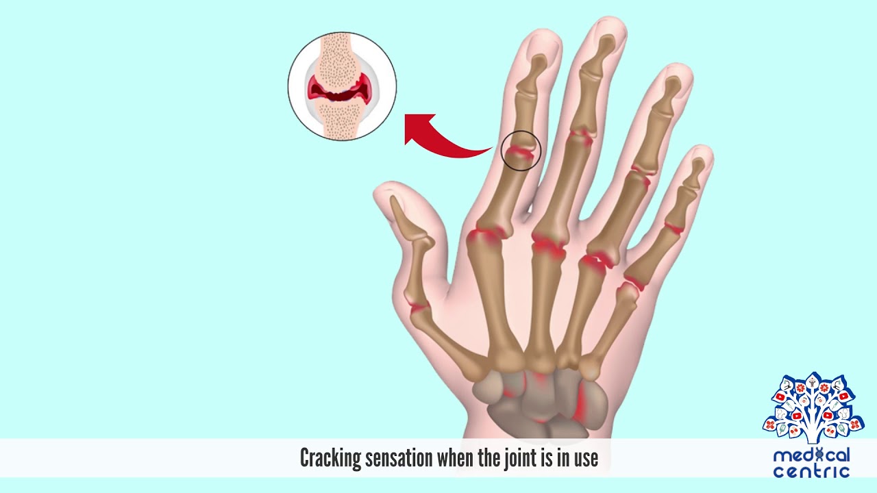 Osteoarthritis, Causes, Signs and Symptoms, Diagnosis and Treatment ...