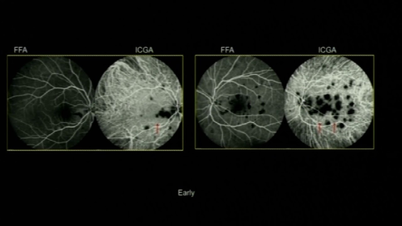 AIOC2018 - IC005 - Topic - Imaging in uveitis – FFA; ICG; OCT & OCTA ...