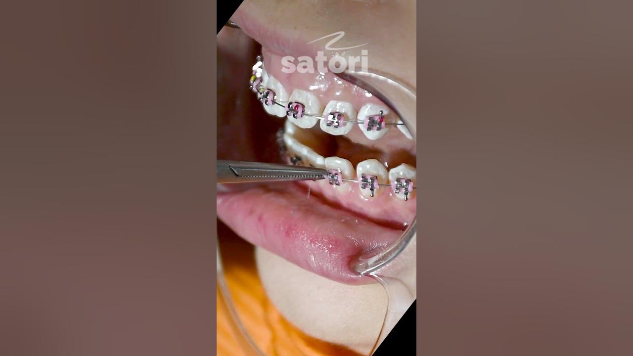 Замена дуги и лигатур на брекетах - YouTube