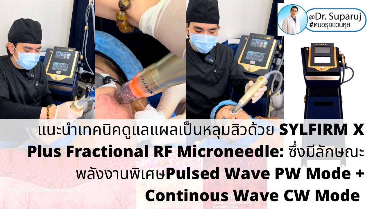 รักษาแผลหลุมสิวด้วย SYLFIRM X Plus Fractional RF Microneedle Pulsed ...