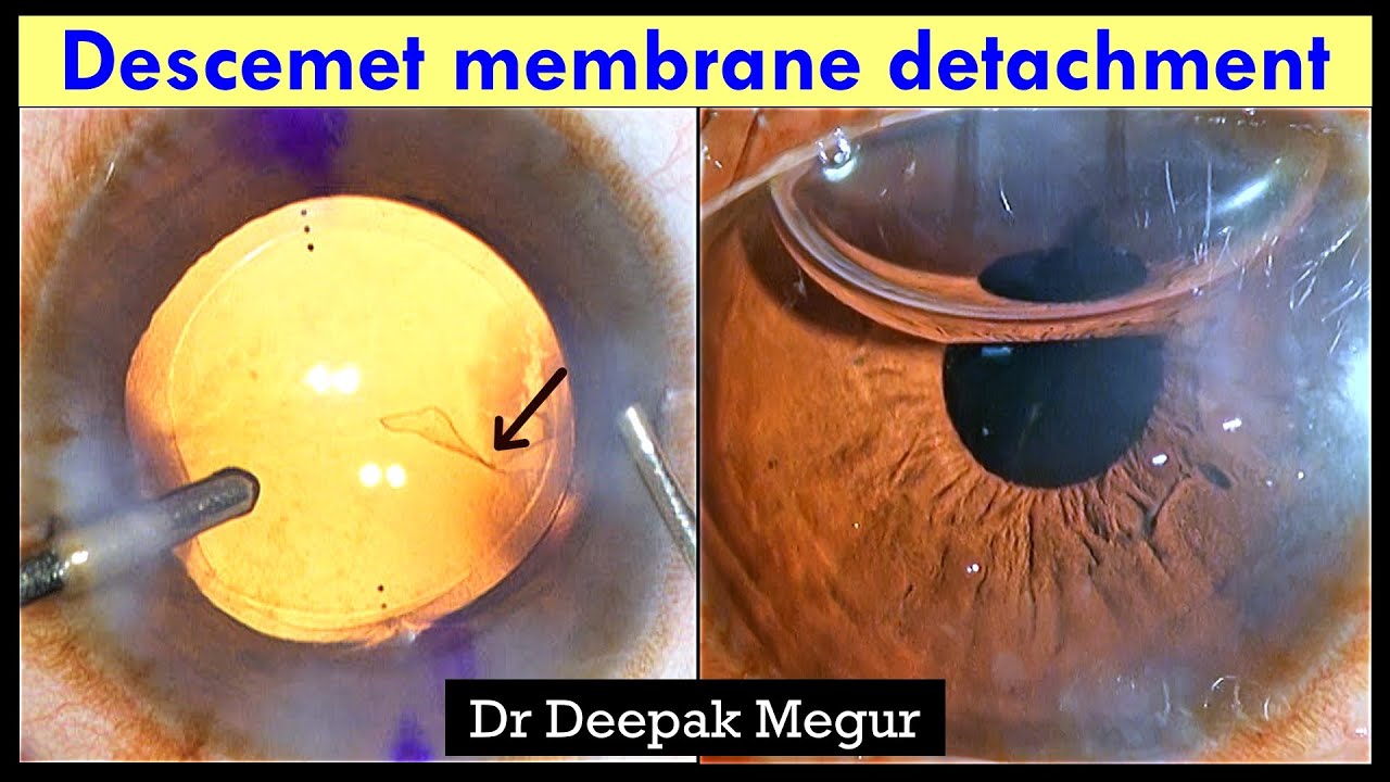 Small Descemet membrane detachment at the side port region (DMD)-Dr ...