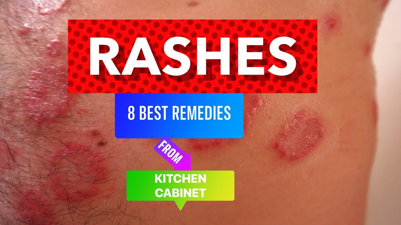 RASHES//8 BEST KITCHEN CABINET REMEDIES - YouTube