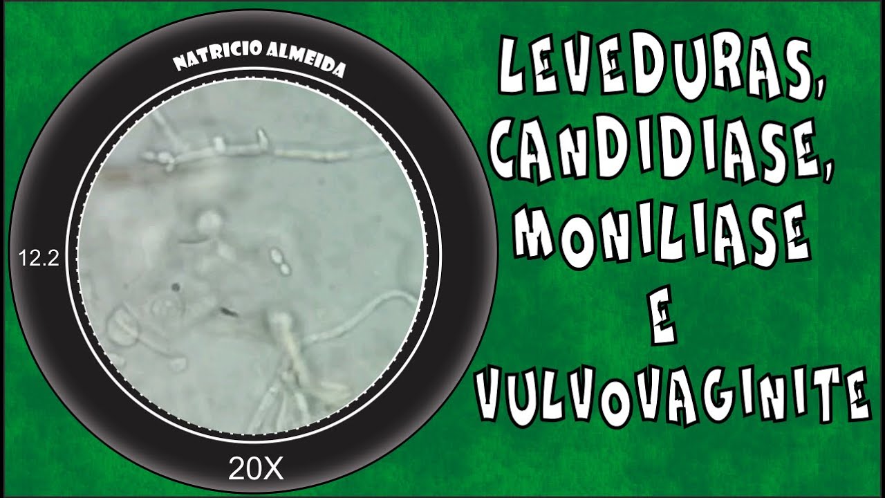 Leveduras na urina, candidíase, monilíase vaginal ou vulvovaginite por ...