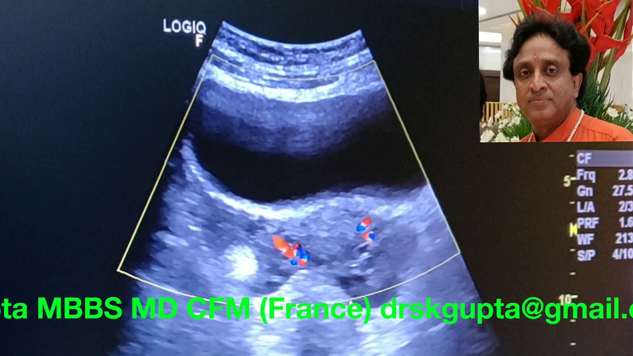 Ovarian Calcification, How to see? Causes and follow up. - YouTube