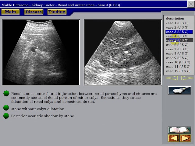 Renal Calculi Ultrasound Images