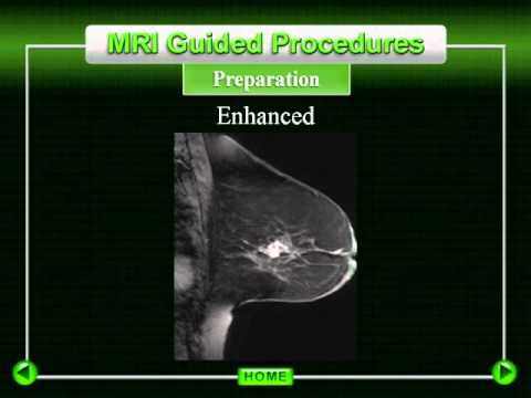 MRI Advance - Breast MRI Lecture Series - P10 A2 CASE REVIEW - YouTube