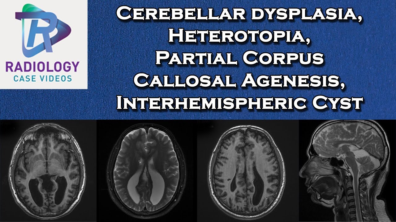 Cerebellar dysplasia, Heterotopia, Partial Corpus Callosal Agenesis ...