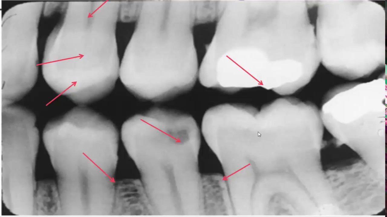 Interprétation du BITEWING : rétro coronaire - YouTube