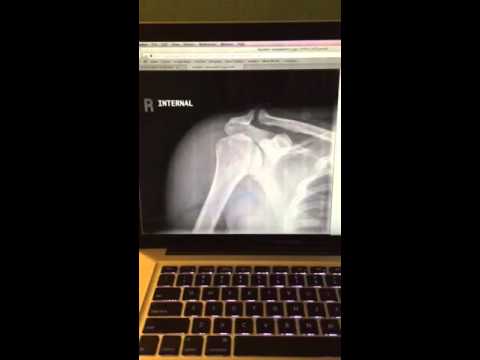 AP Shoulder (Internal Rotation) - YouTube