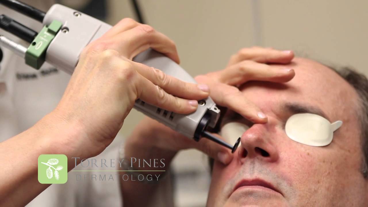 Vbeam™ Treatment (pulsed-dye laser that precisely targets visible red ...