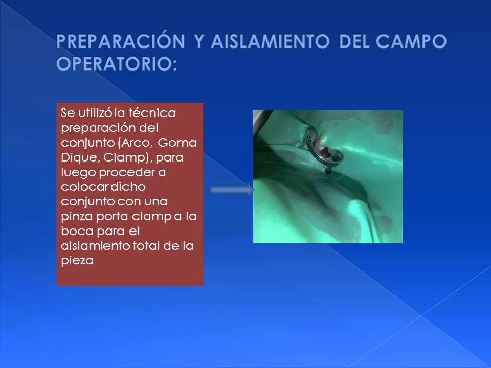 NECROPULPECTOMIA EN PIEZAS DENTALES UNIRADICULARES con IRRIGACION DE ...