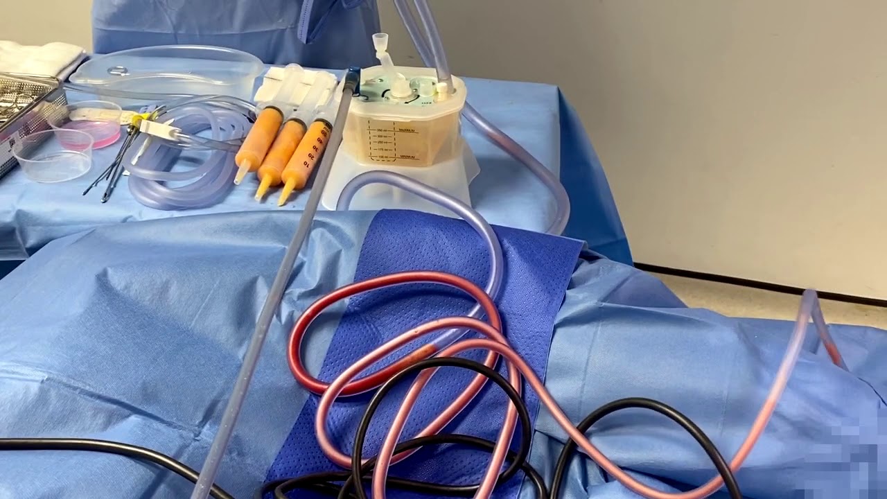 Abdominal Fat Transfer - an alternative for enhancement without abdomen ...