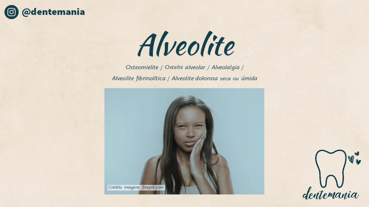 Alveolite dentária (Osteíte alveolar/Osteomielite) - YouTube