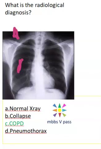 Radiology COPD Chest Xray Image Spotter MCQ - YouTube