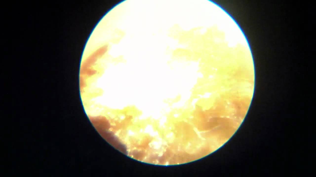 My kidney stone under microscope - YouTube