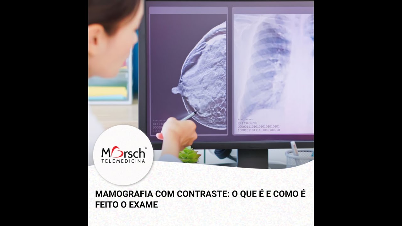 MAMOGRAFIA COM CONTRASTE: O QUE É E COMO É FEITO O EXAME - YouTube