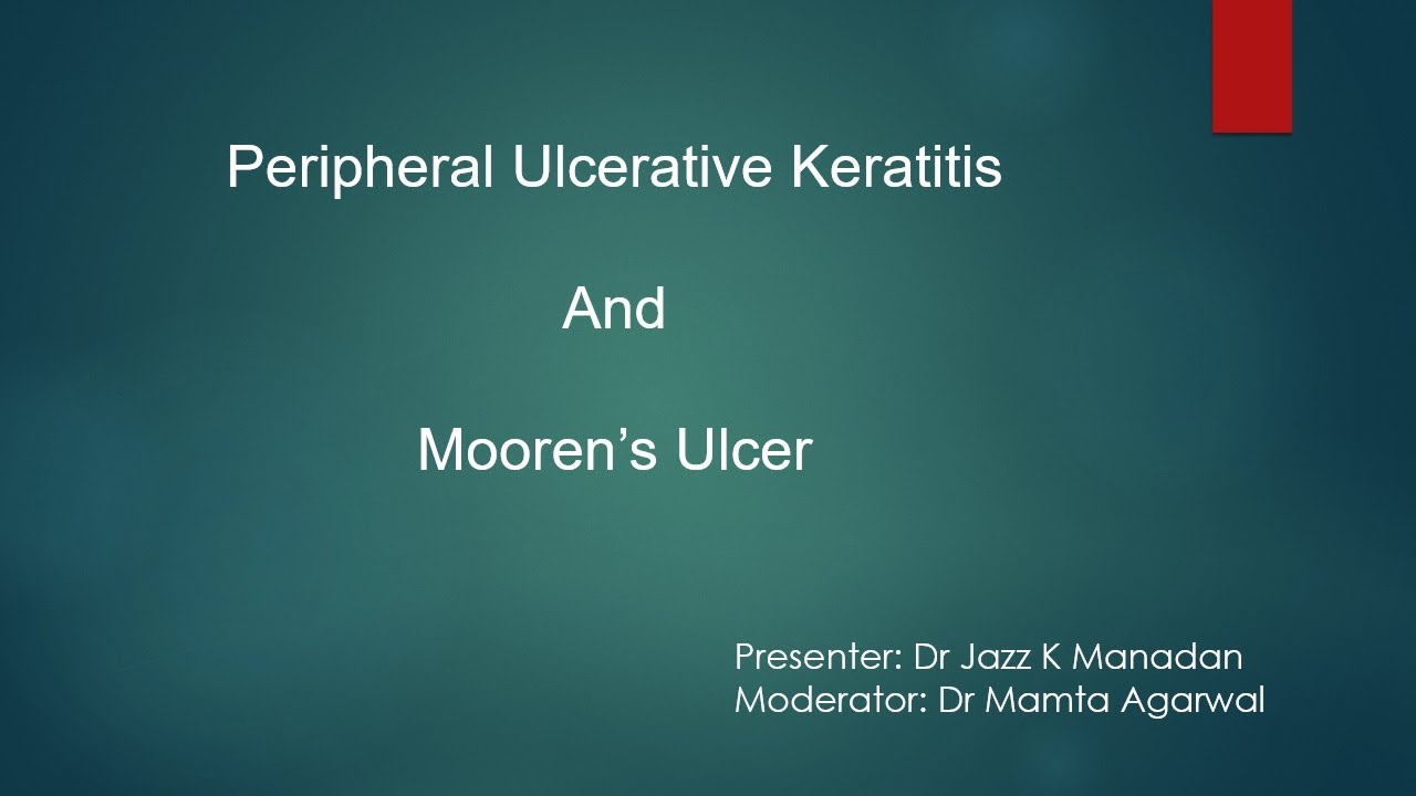 Peripheral Ulcerative Keratitis And Moorens Ulcer, Dr Jazz K Manadan ...