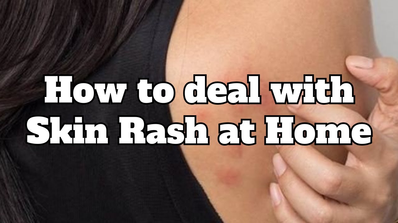 NHS How to deal with Skin Rash - YouTube