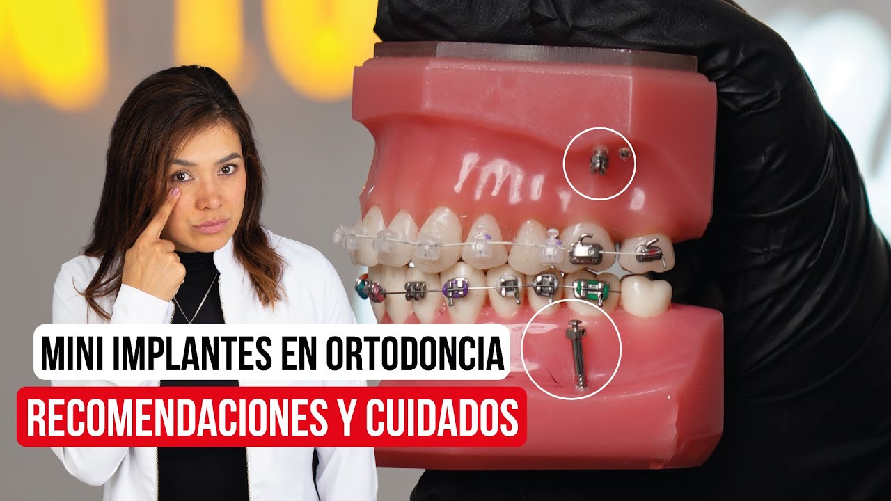 Mini implantes en ortodoncia: Recomendaciones y cuidados - YouTube