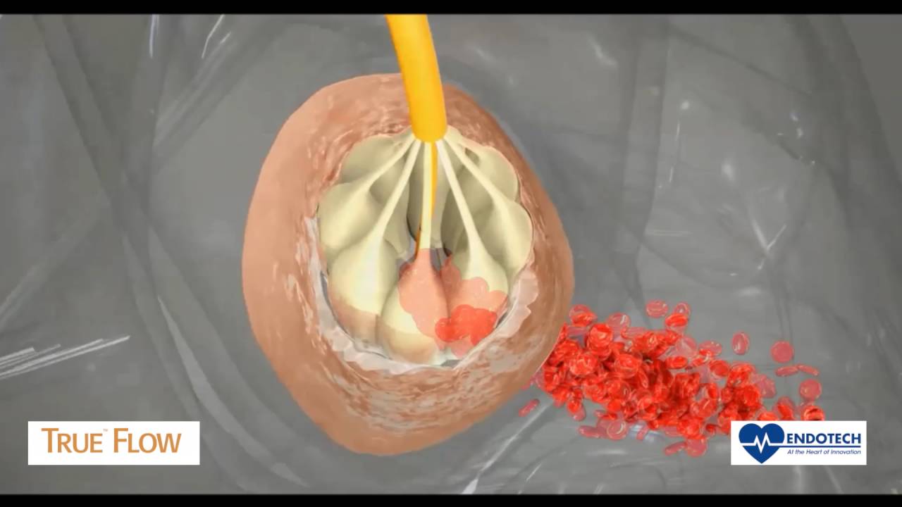 TRUEFLOW - Catetere a perfusione per Valvuloplastica Aortica - YouTube