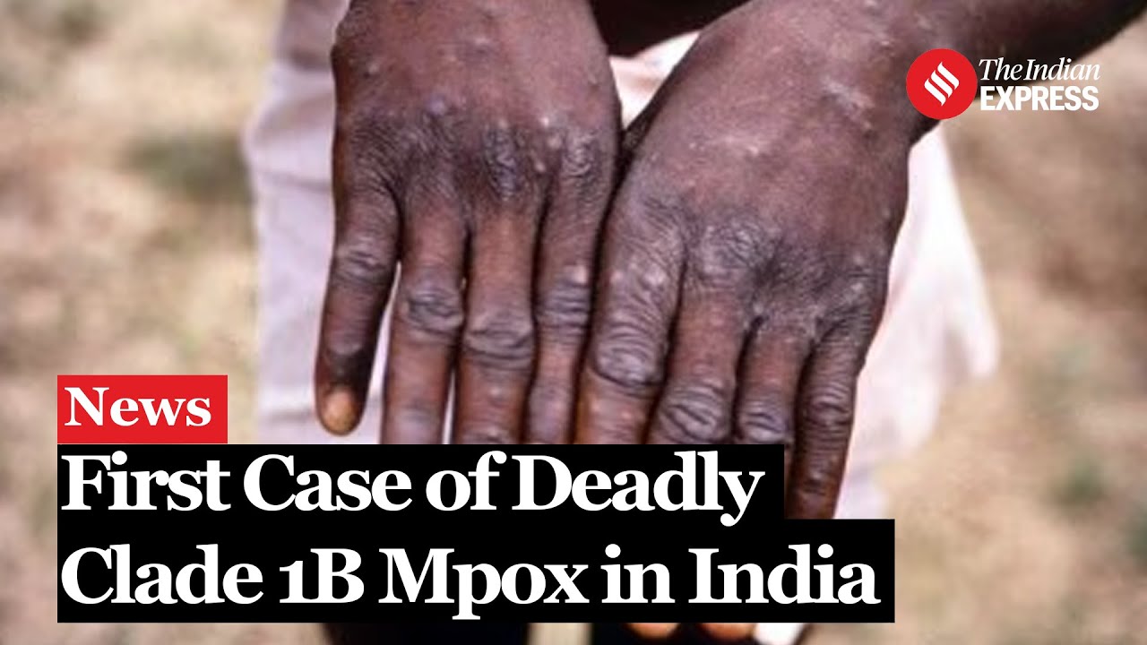 India Reports First Case of Deadly Clade 1B Mpox, Raising Global Health ...