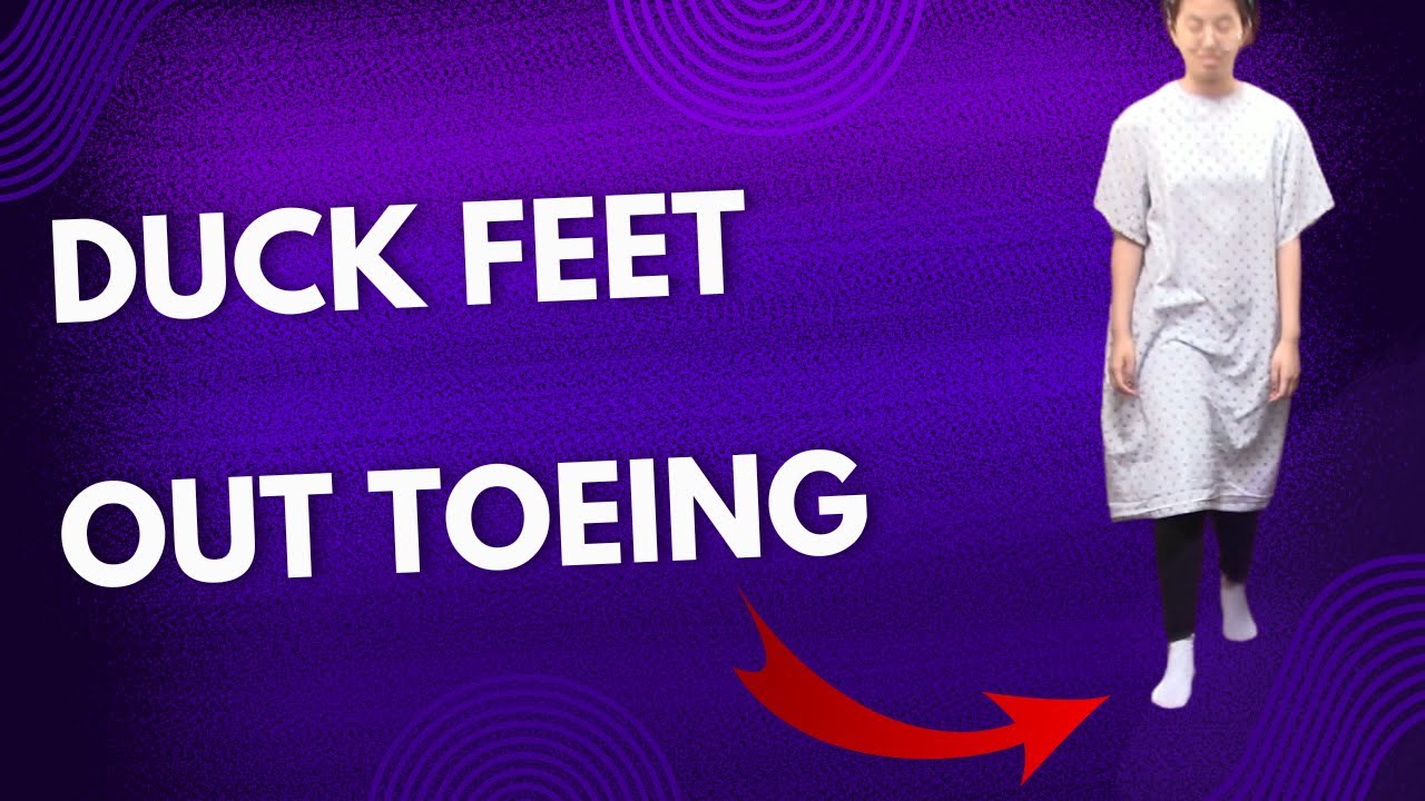 Duck Feet, Duck Toe, Out Toeing HELPED by Dr Suh Chiropractic - YouTube