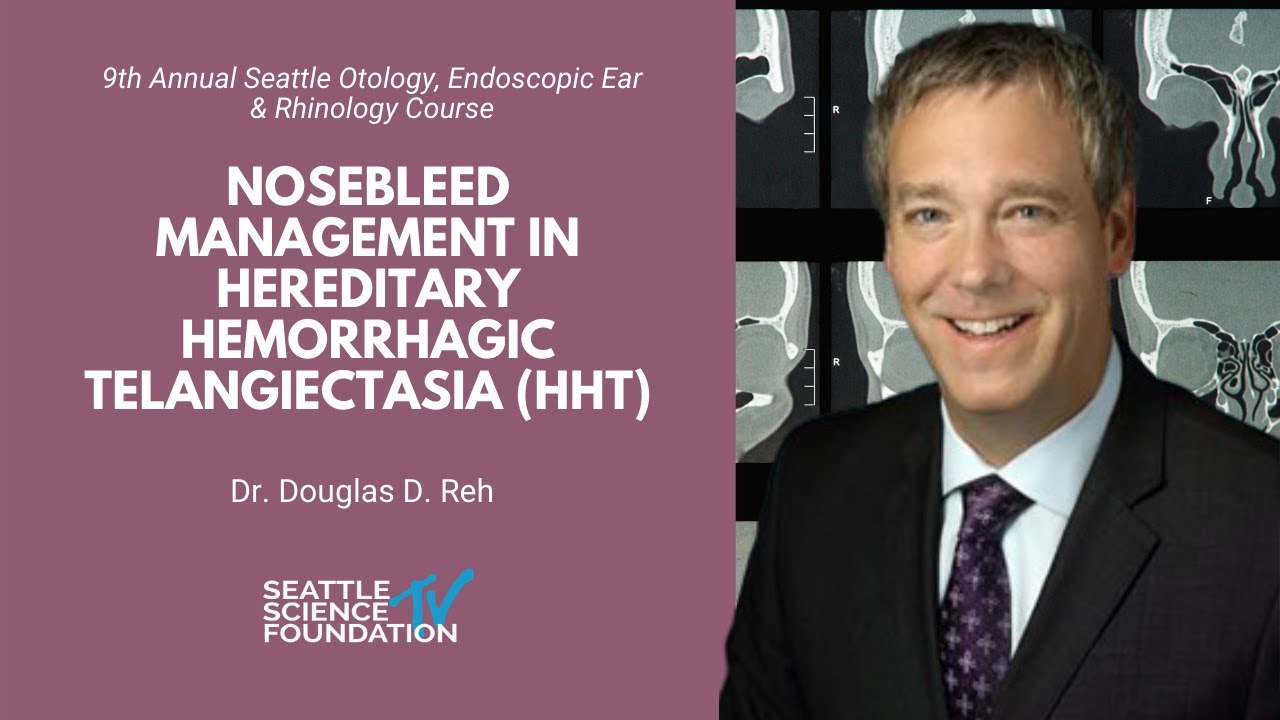 Nosebleed Management in Hereditary Hemorrhagic Telangiectasia HHT ...