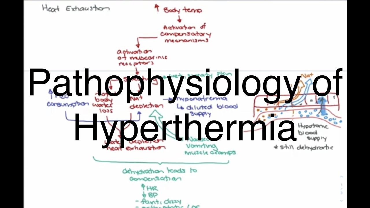 Hyperthermia Pathophysiology - YouTube