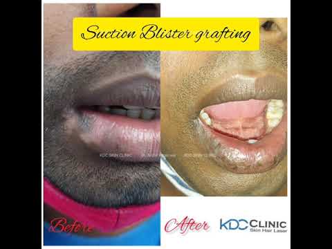 Suction Blister grafting results| Patient Testimonial - YouTube