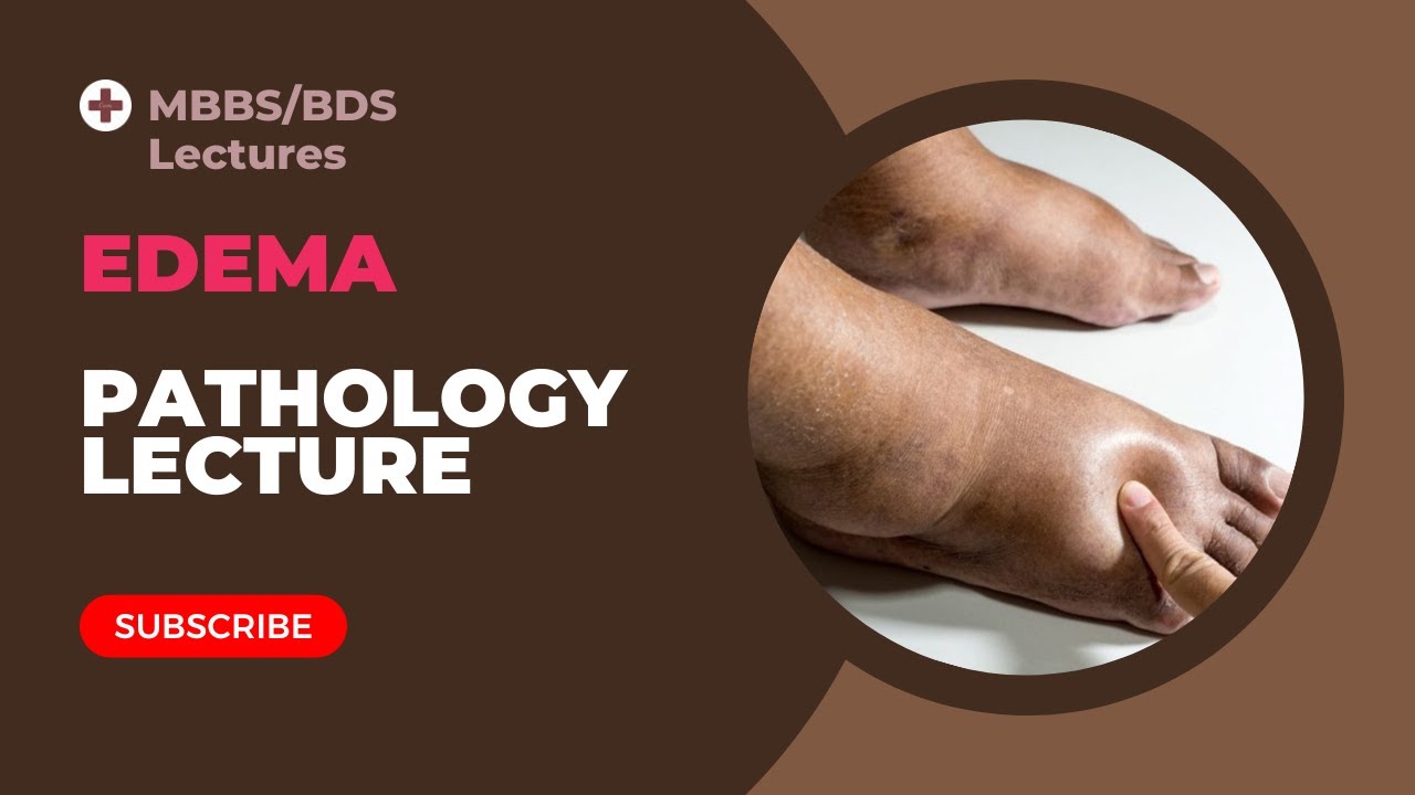 Edema Pathology Lecture || MBBS BDS Second year - YouTube