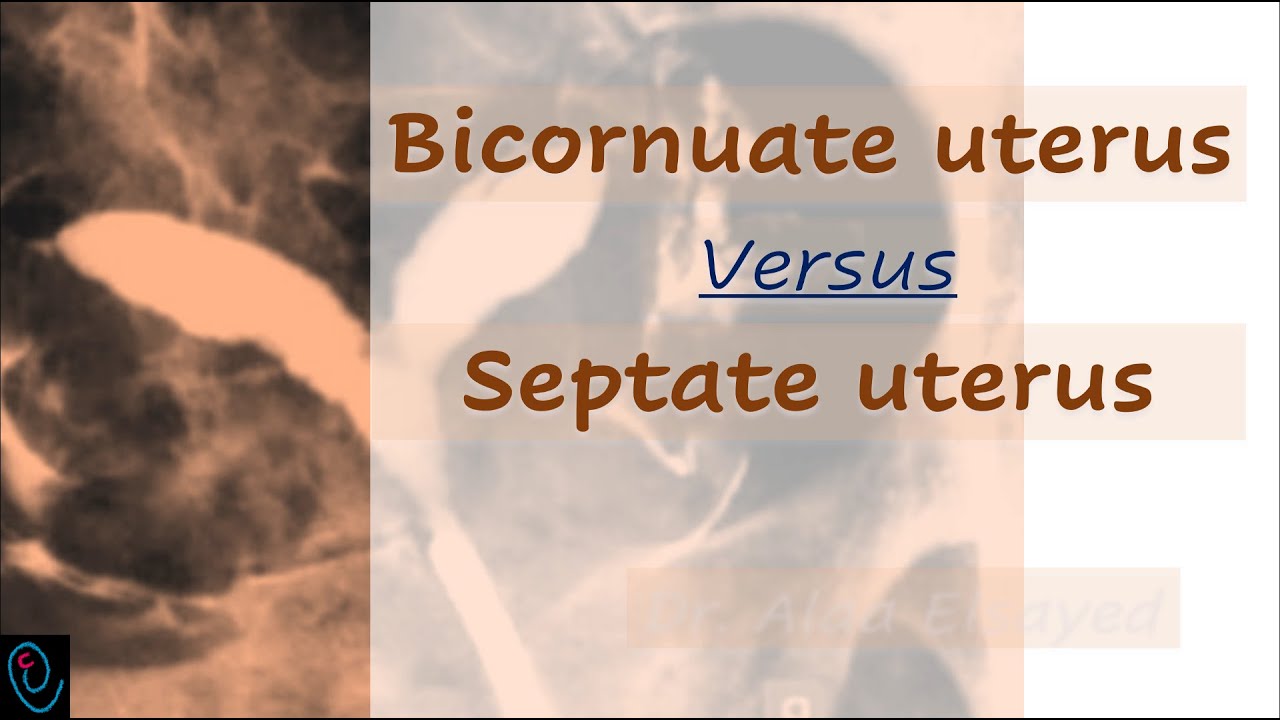 Bicornuate Versus Septate Uterus Youtube