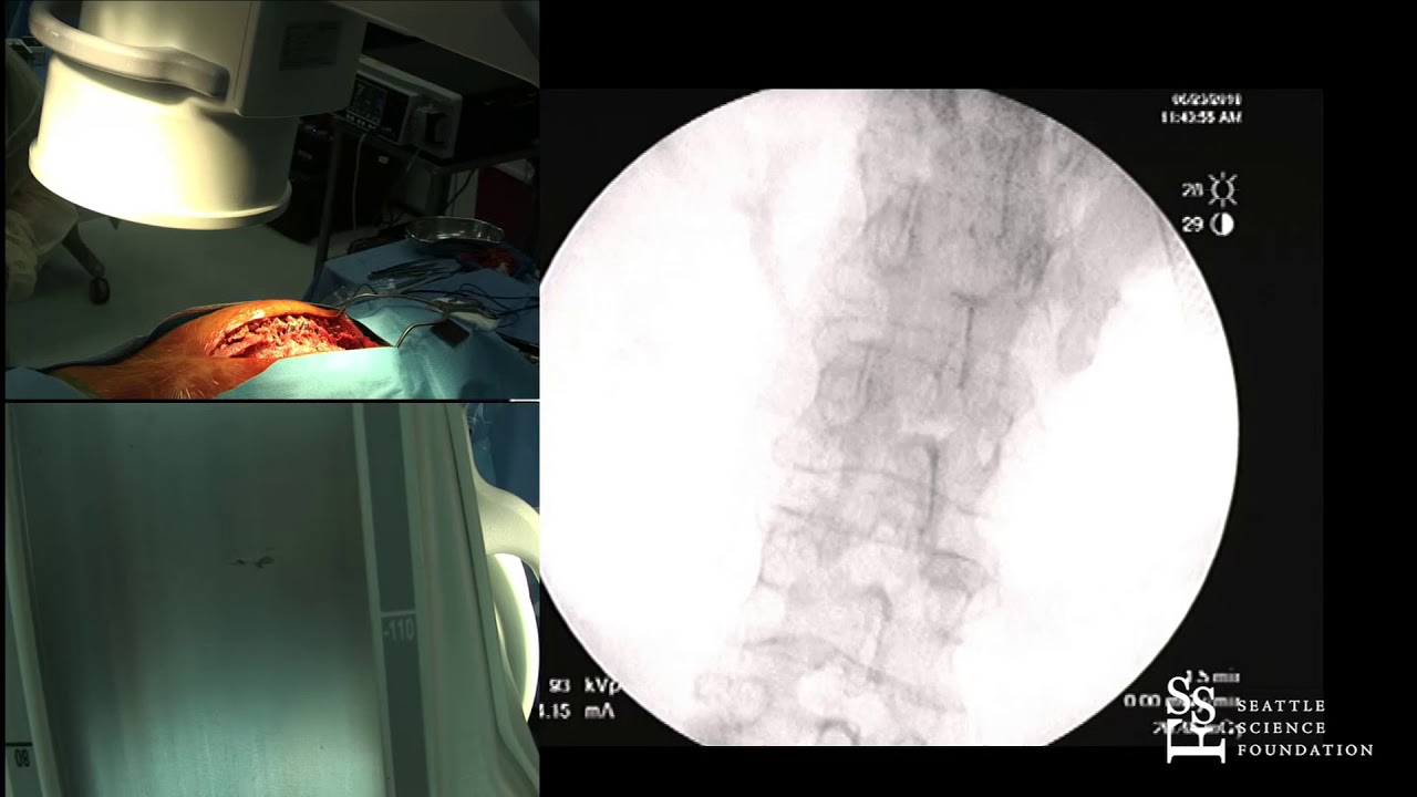 Live Demo - Use of Power in Spinal Deformity Surgery - David Skaggs, MD ...