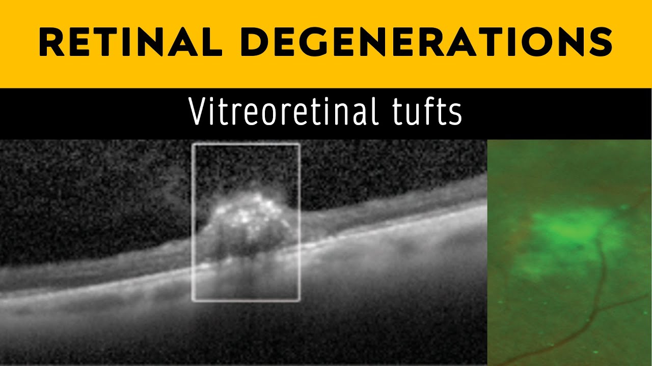 Vitreo-Retinal Tufts | Peripheral retinal Degenerations | - YouTube