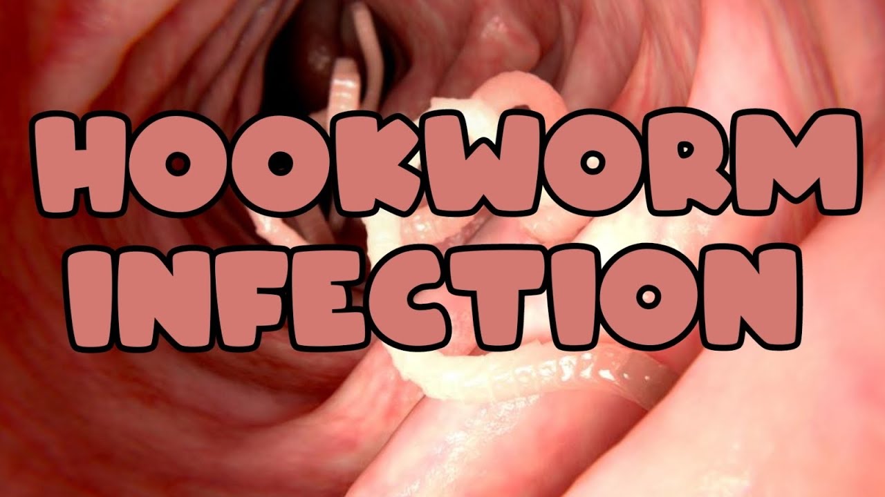 Hookworm infections | Life cycle | Pathogenesis | Lab diagnosis | GIT microbiology - YouTube
