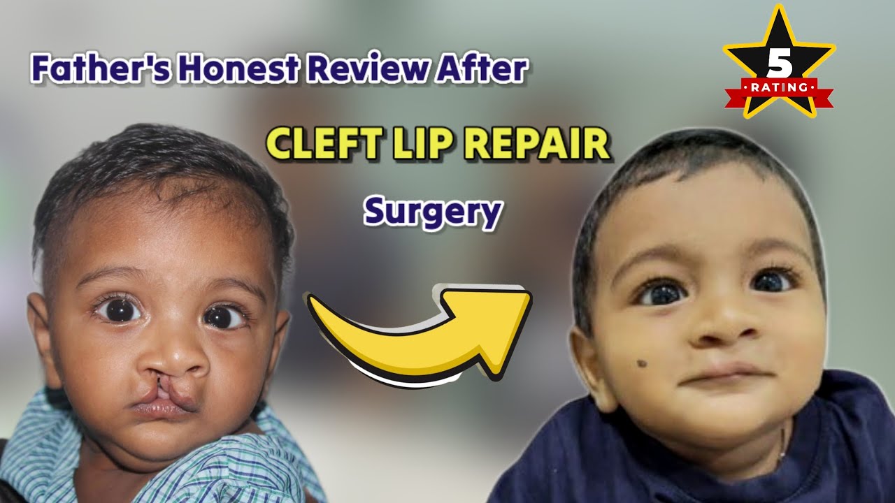 Happy and Thankful : Father's Honest Review After Child's Cleft Lip ...