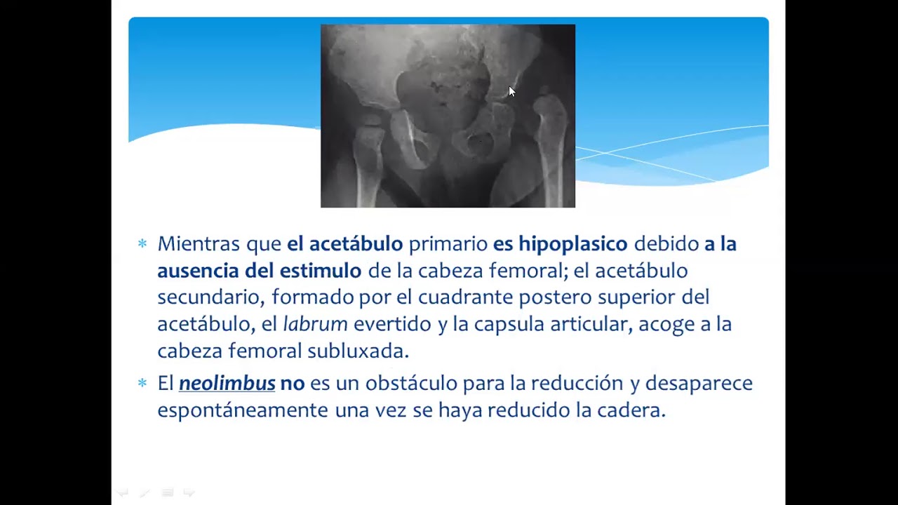 DISPLASIA DEL DESARROLLO DE LA CADERA DR DAVID SANTIAGO TAFFINDER ...