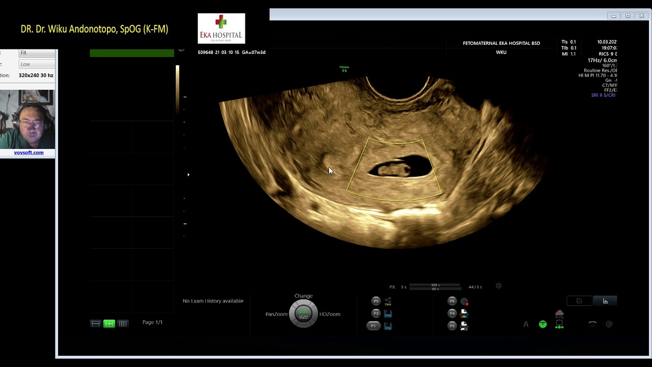KEHAMILAN NORMAL 7 MINGGU (Dr Wiku Andonotopo) - YouTube