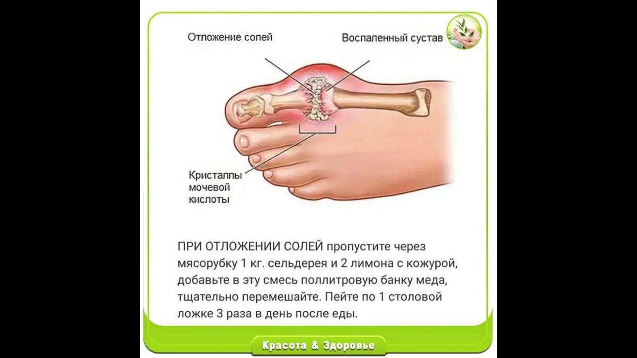 Наш организм: При отложении солей в суставах…/25.03.22 - YouTube