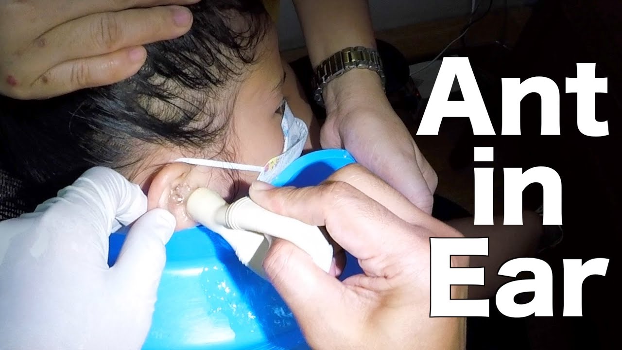 Removing An Ant Stuck & Lodged in Girl's Ear for Days - YouTube
