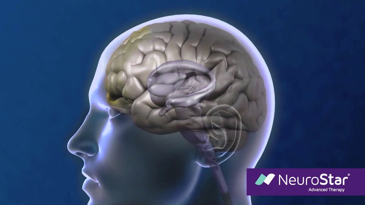 How NeuroStar Works ES - YouTube