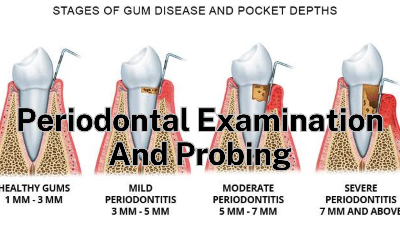 Periodontal Examination And Probing - YouTube