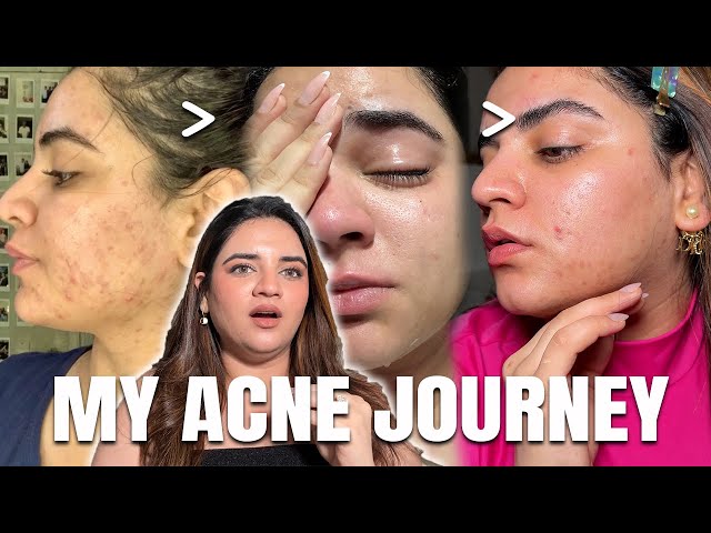 Pcos Before And After Acne
