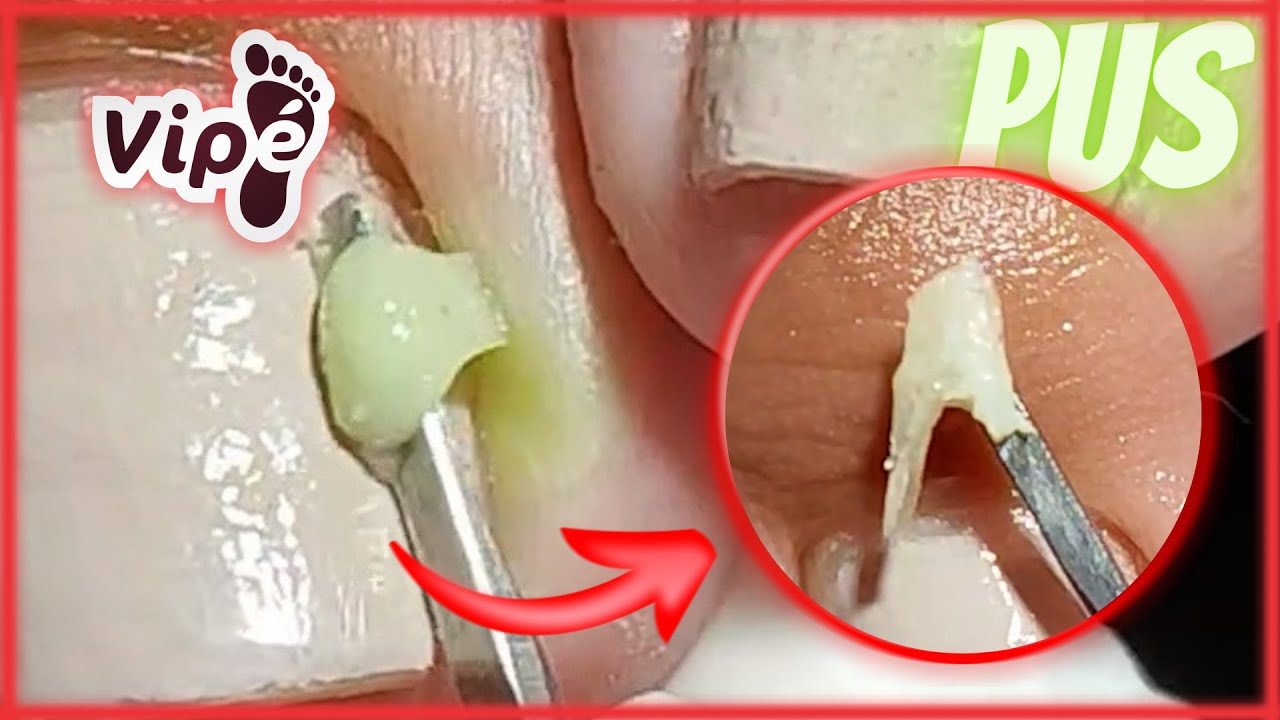 PODOLOGIA EM UNHA ENCRAVADA COM MUITO PUS (OVERGROWN INFECTED INGROWN ...
