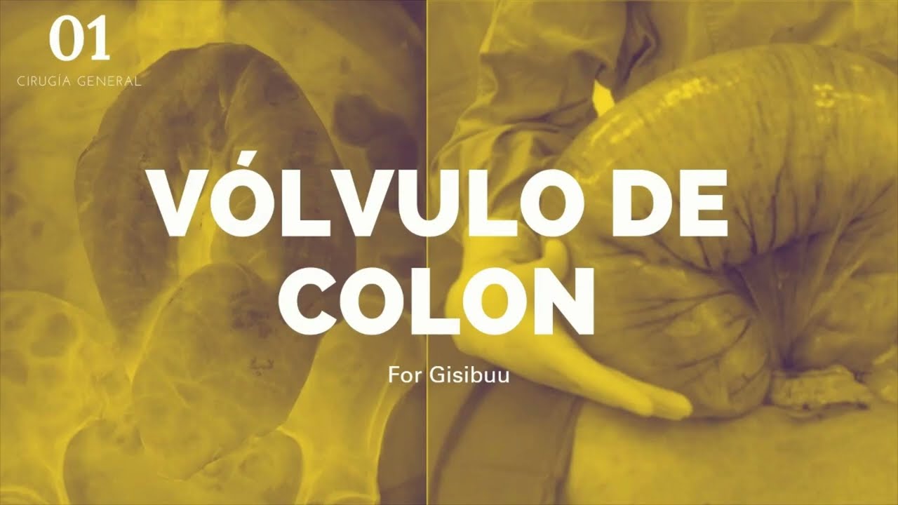 Vólvulo de colon - ENARM - YouTube