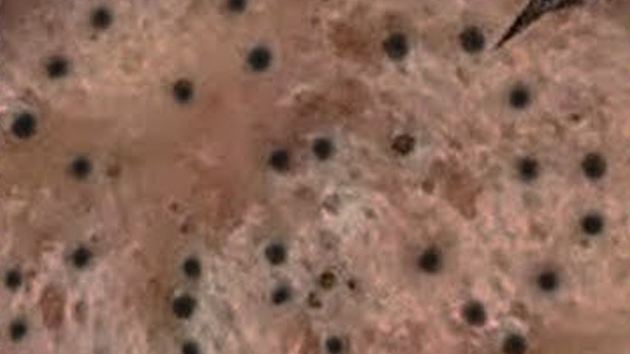 Most Satisfying Video Face Skin Care - YouTube