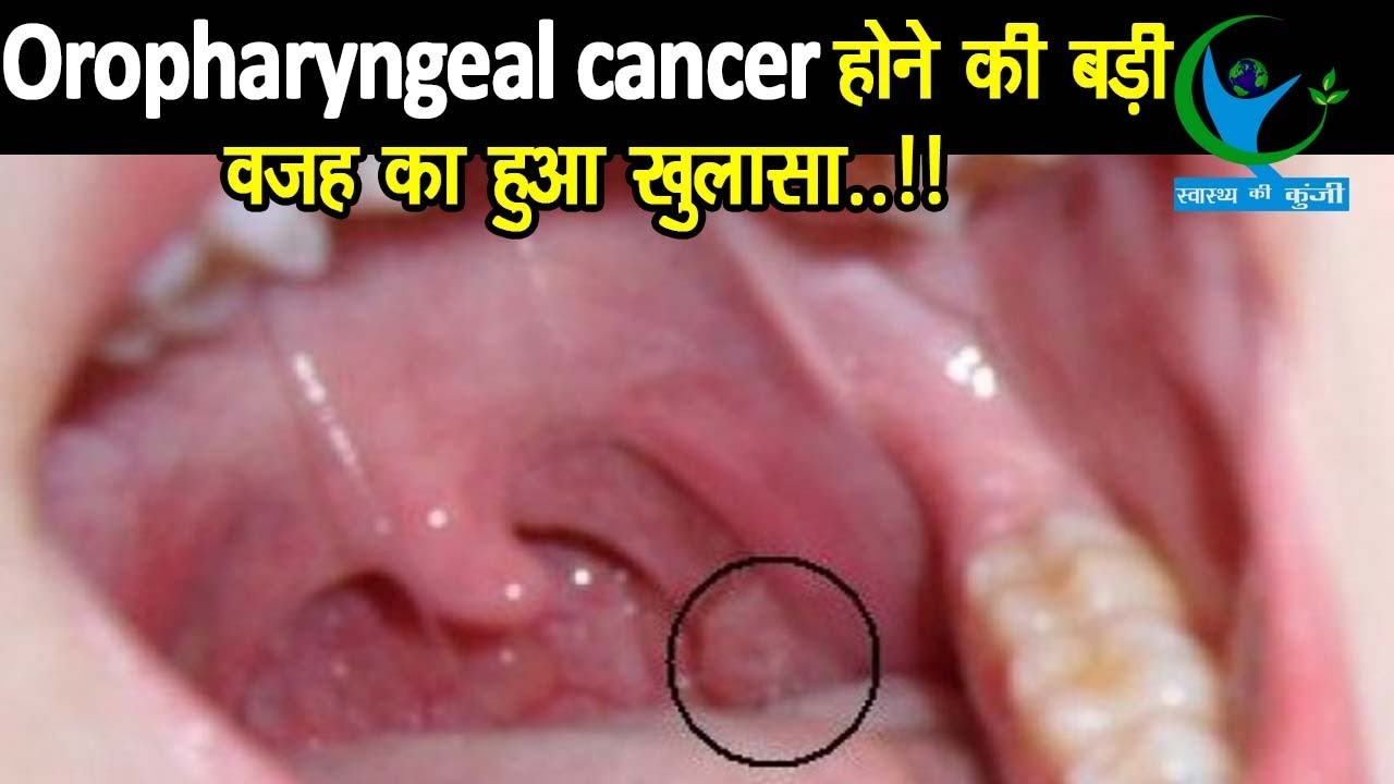 Oropharyngeal Cancer! मुख और गले के कैंसर मरीजों के आंकड़ों को सुनकर ...