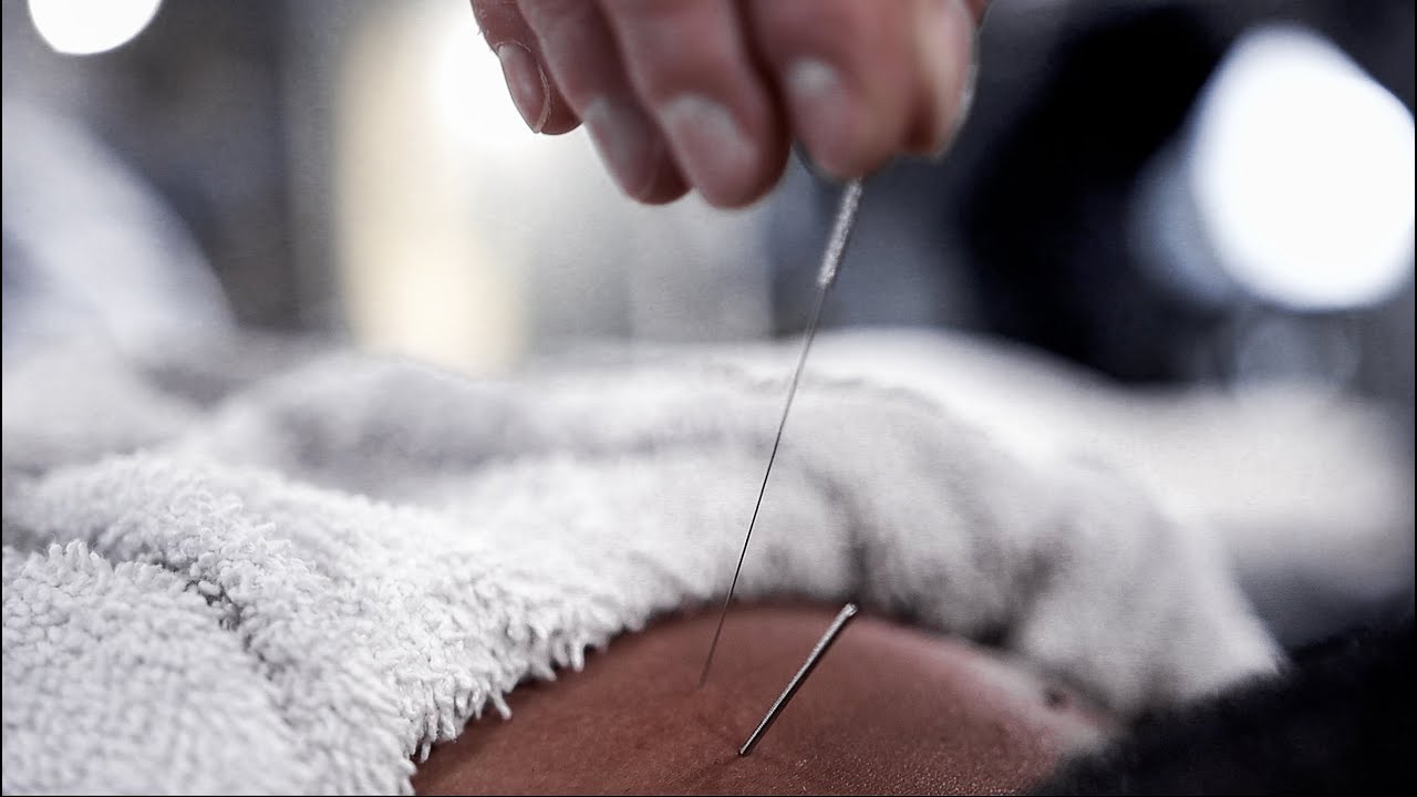 DEEP DRY NEEDLING - YouTube