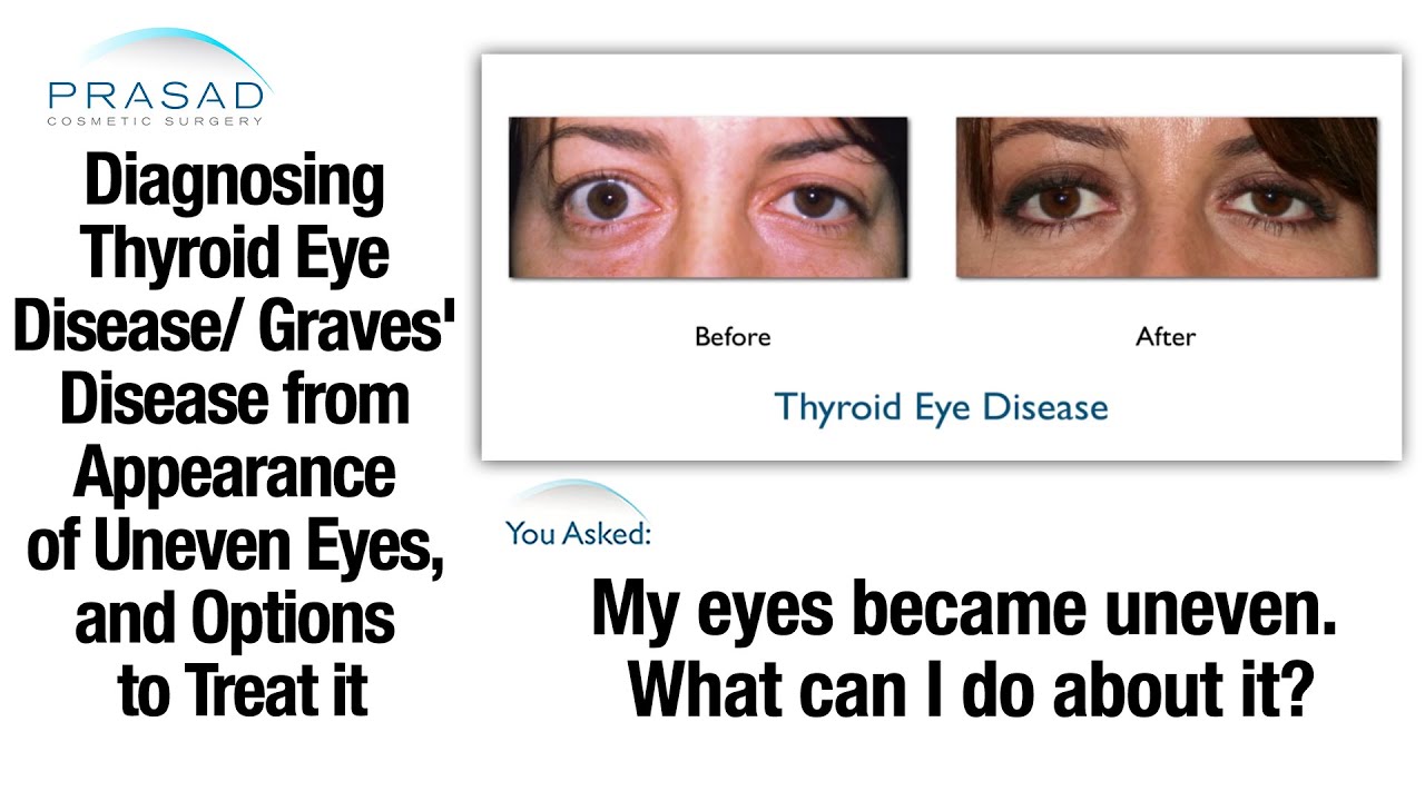 Thyroid Problems Can Cause Uneven Eyes Diagnosis And Eye Hot Sex Picture