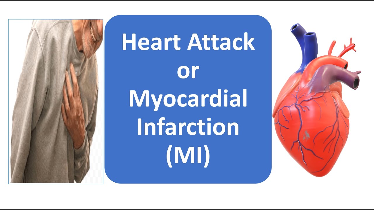 Heart attack | Myocardial infarction (MI) | Acute MI | Coronary ...
