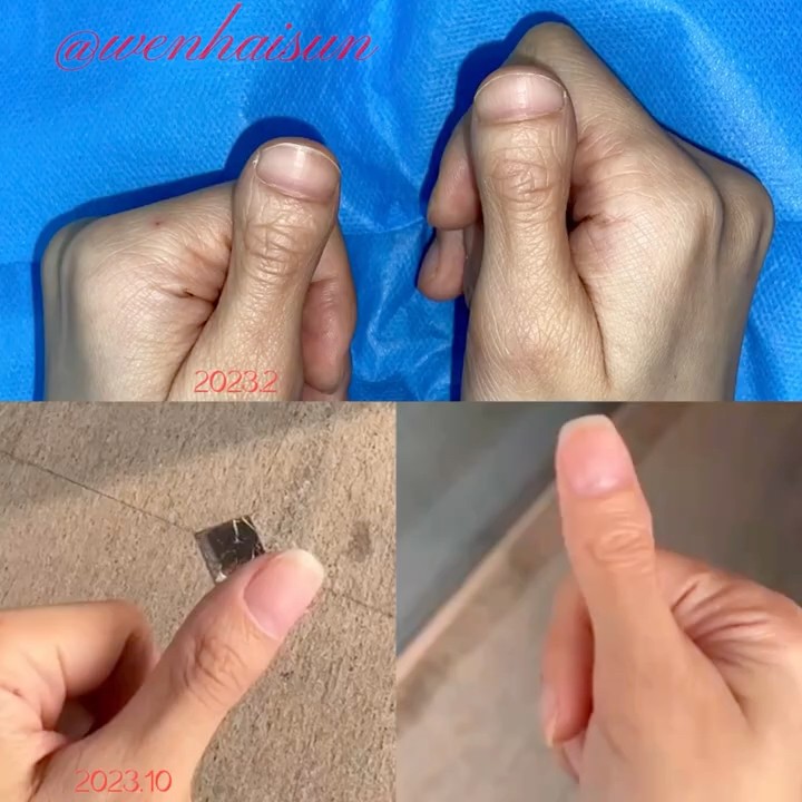 Stub thumb lengthening. #Brachydactyly #MegenFox #Doctor #Thumb # ...
